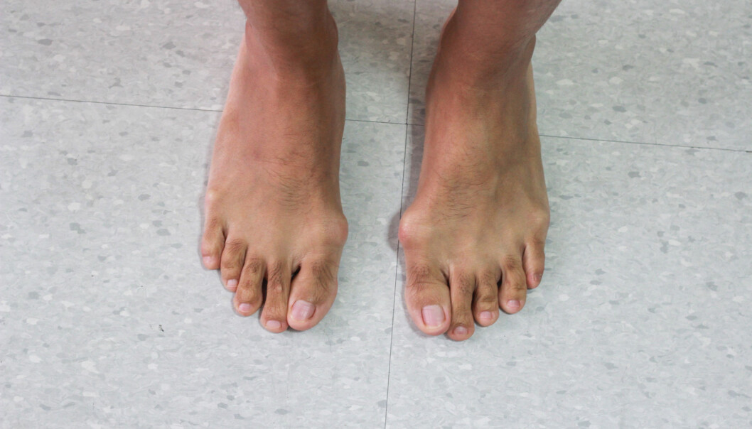 Nytt håp for pasienter med urinsyregikt